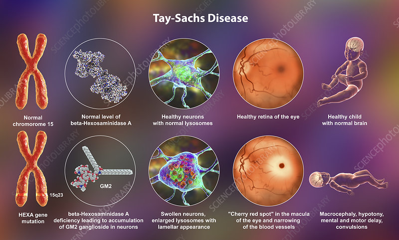 Tay-Sachs Disease (TSD) – 1 in Every 320,000 Babies Born in the U.S ...