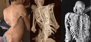 Fibrodysplasia Ossificans Progressiva (FOP) – 1/1,000,000 People Affected – Rare Disease Insights