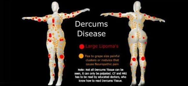 Dercum’s Disease – Prevalence Unknown – Rare Disease Insights