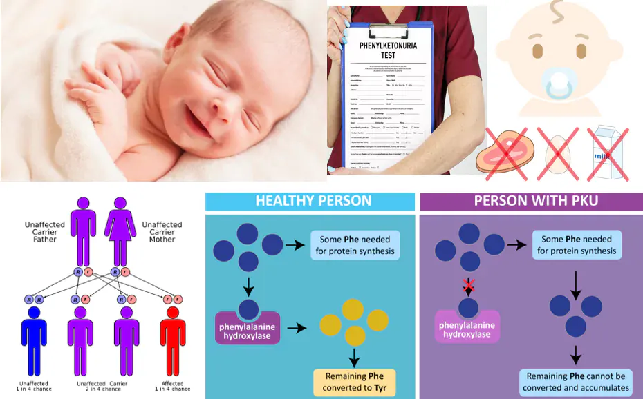 Phenylketonuria (PKU) – 1/19,000 People – Rare Disease Insights