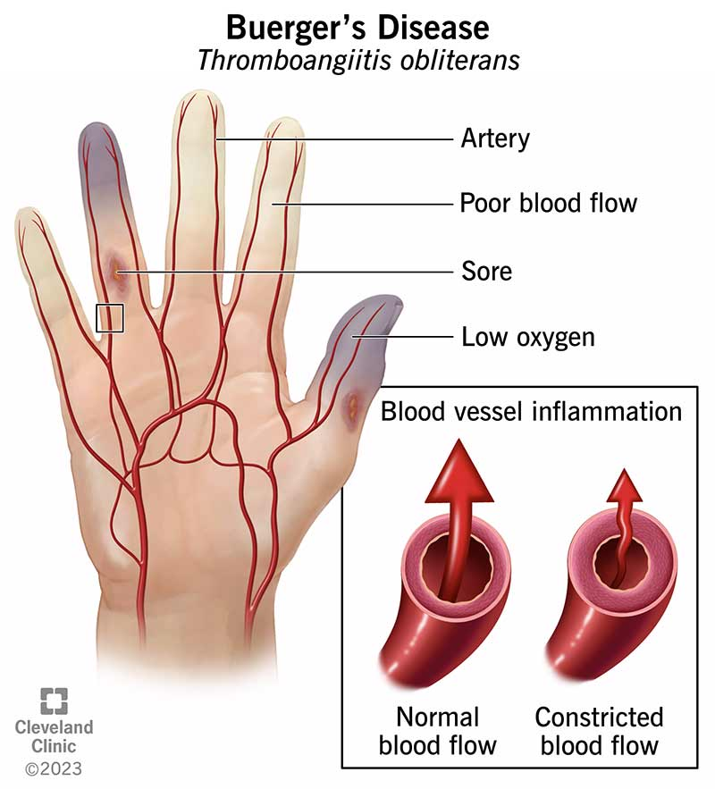 Buerger’s Disease – 12.6-20/100,000 People Affected – Rare Disease Insights