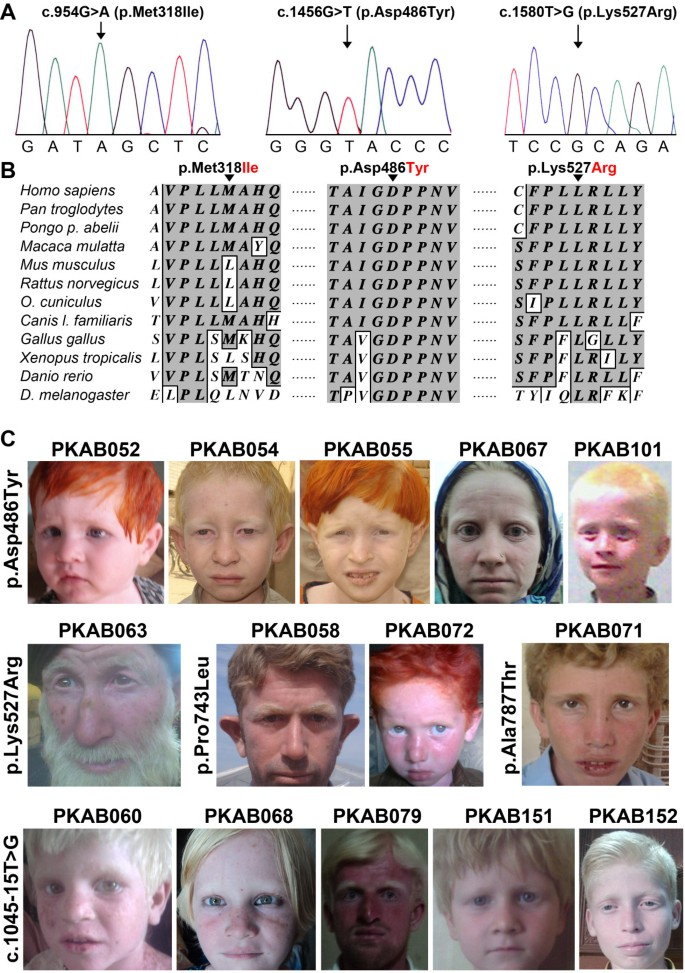 Oculocutaneous Albinism – 1/20,000 People Worldwide – Rare Disease Insights