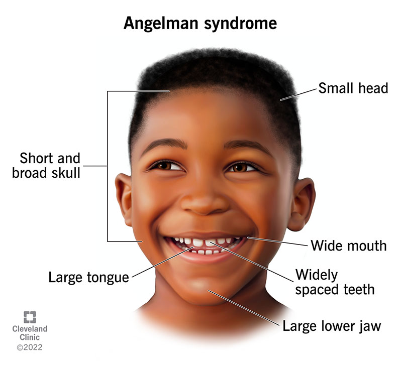 Angelman Syndrome – 1 in 12,000-20,000 People Affected – Rare Disease ...