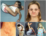 Congenital Insensitivity to Pain (CIP) – 1 in a Million People – Rare ...