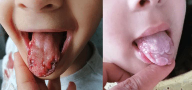 Congenital Insensitivity to Pain (CIP) – 1 in a Million People – Rare ...