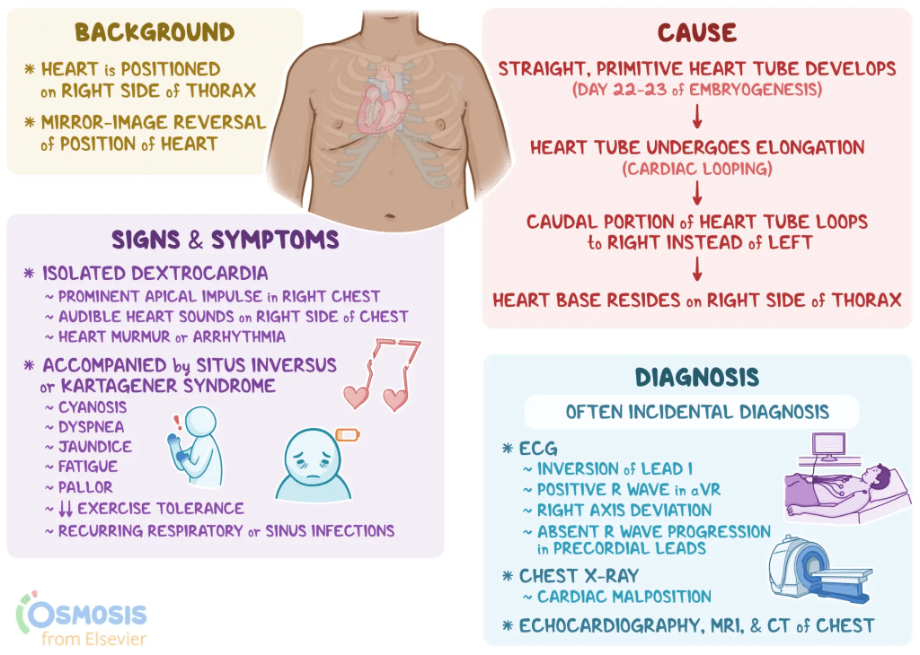 Dextrocardia with Situs Inversus – 1 in 10,000 to 1 in 35,000 Live ...