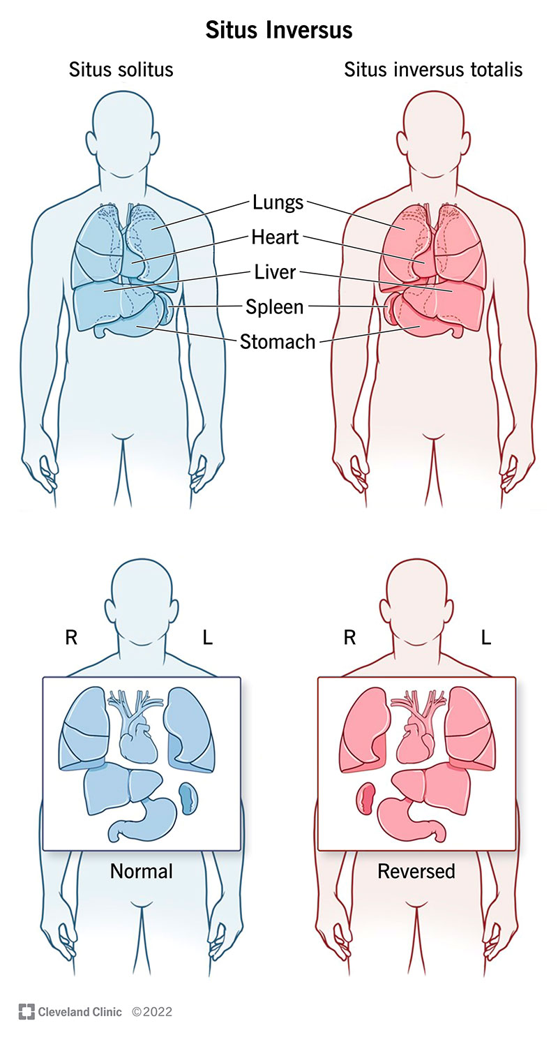 Dextrocardia with Situs Inversus – 1 in 10,000 to 1 in 35,000 Live ...